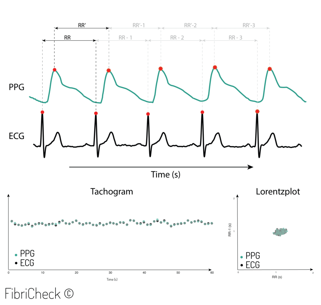 Fibricheck Beat To Beat Accuracy Compared With Wearable Ecg In Broad